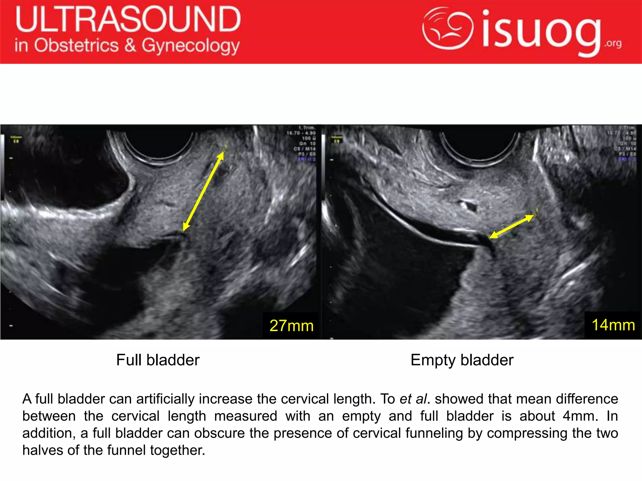 Como medir la longitud cervical.ppt
