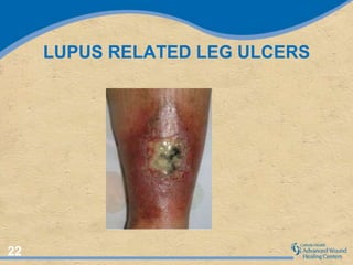 Medical Comorbidities and their impacto on wound healing | PPTX
