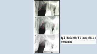 Comparative study of DFDBA and FDBA block grafts.pptx | Bone and Joint ...