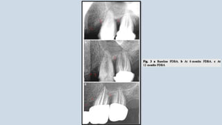 Comparative study of DFDBA and FDBA block grafts.pptx