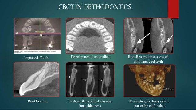 Comparison of ct and cbct