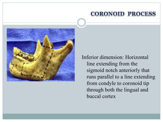 Comparison of intraoral harvest sites for corticocancellous bone grafts ...