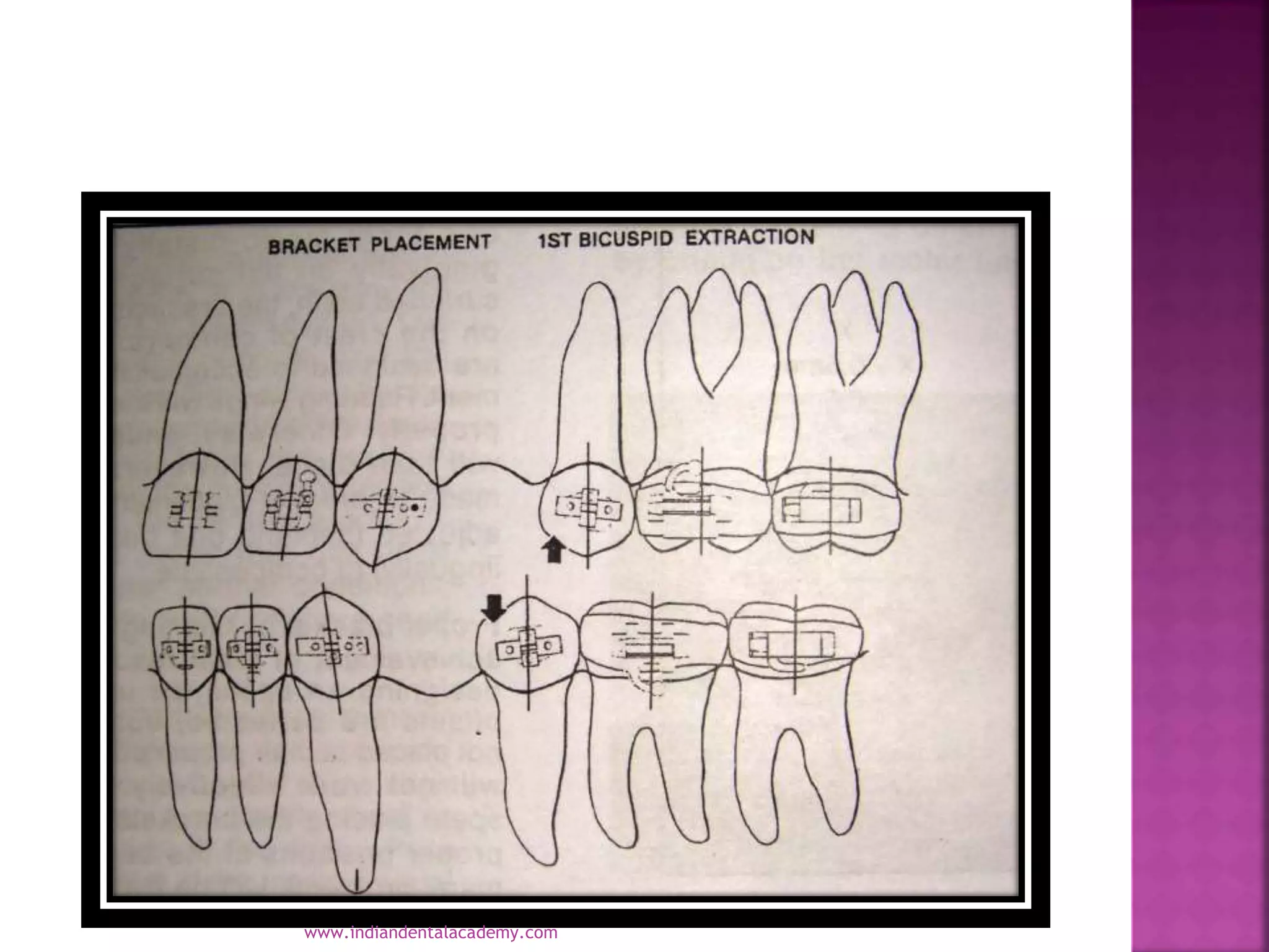 Comparison of The Roth prescription,Alexander prescription & MBT ...