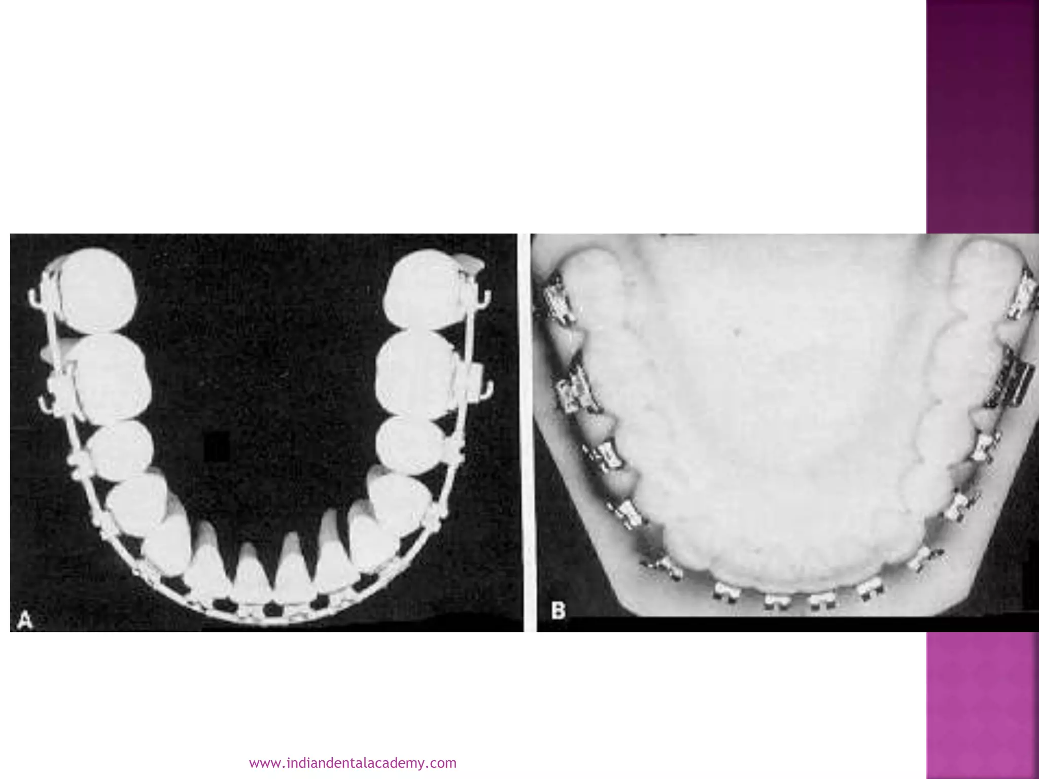 Comparison of The Roth prescription,Alexander prescription & MBT ...