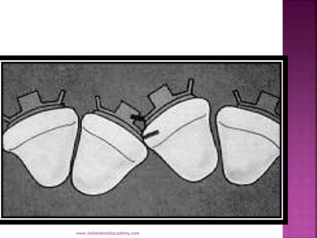 Comparison of The Roth prescription,Alexander prescription & MBT ...