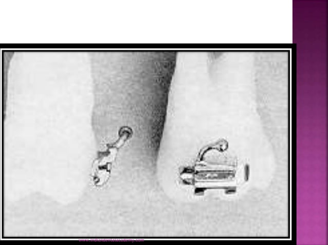 Comparison of The Roth prescription,Alexander prescription & MBT ...