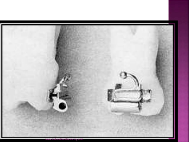 Comparison of The Roth prescription,Alexander prescription & MBT ...