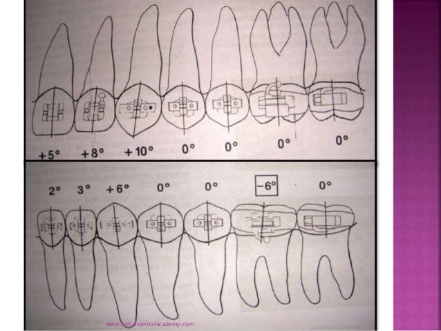 Comparison of The Roth prescription,Alexander prescription & MBT pres…