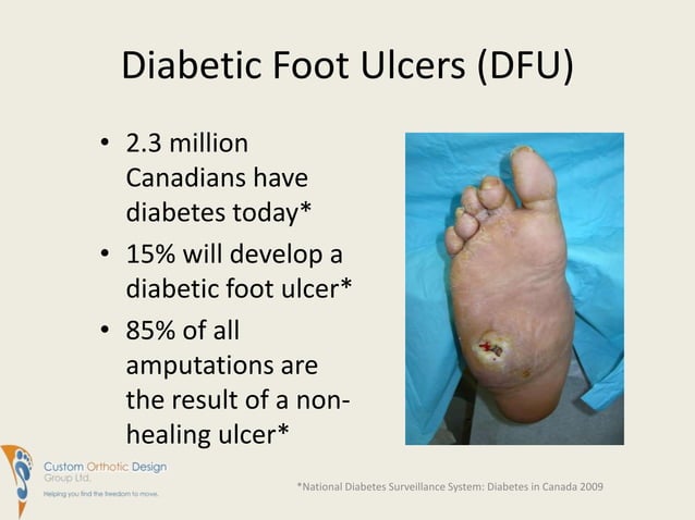 Diabetic Foot Ulcers - Comparison of Cast Alternatives | PPTX ...
