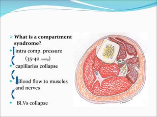 Compartment syndrome | PPT