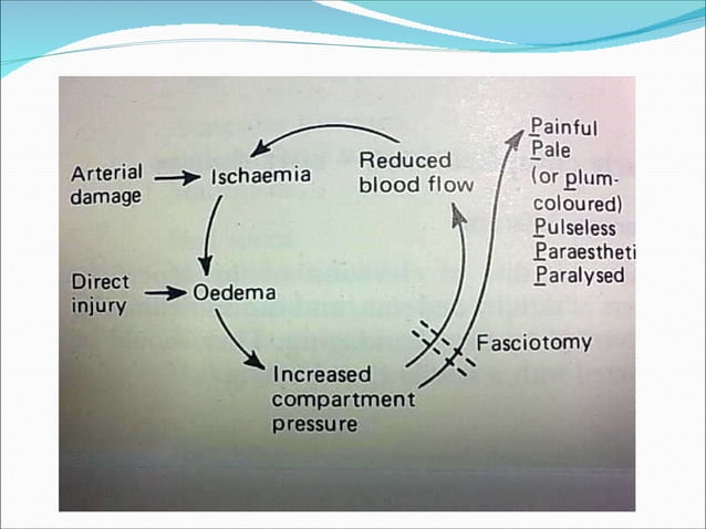 Compartment syndrome | PPT