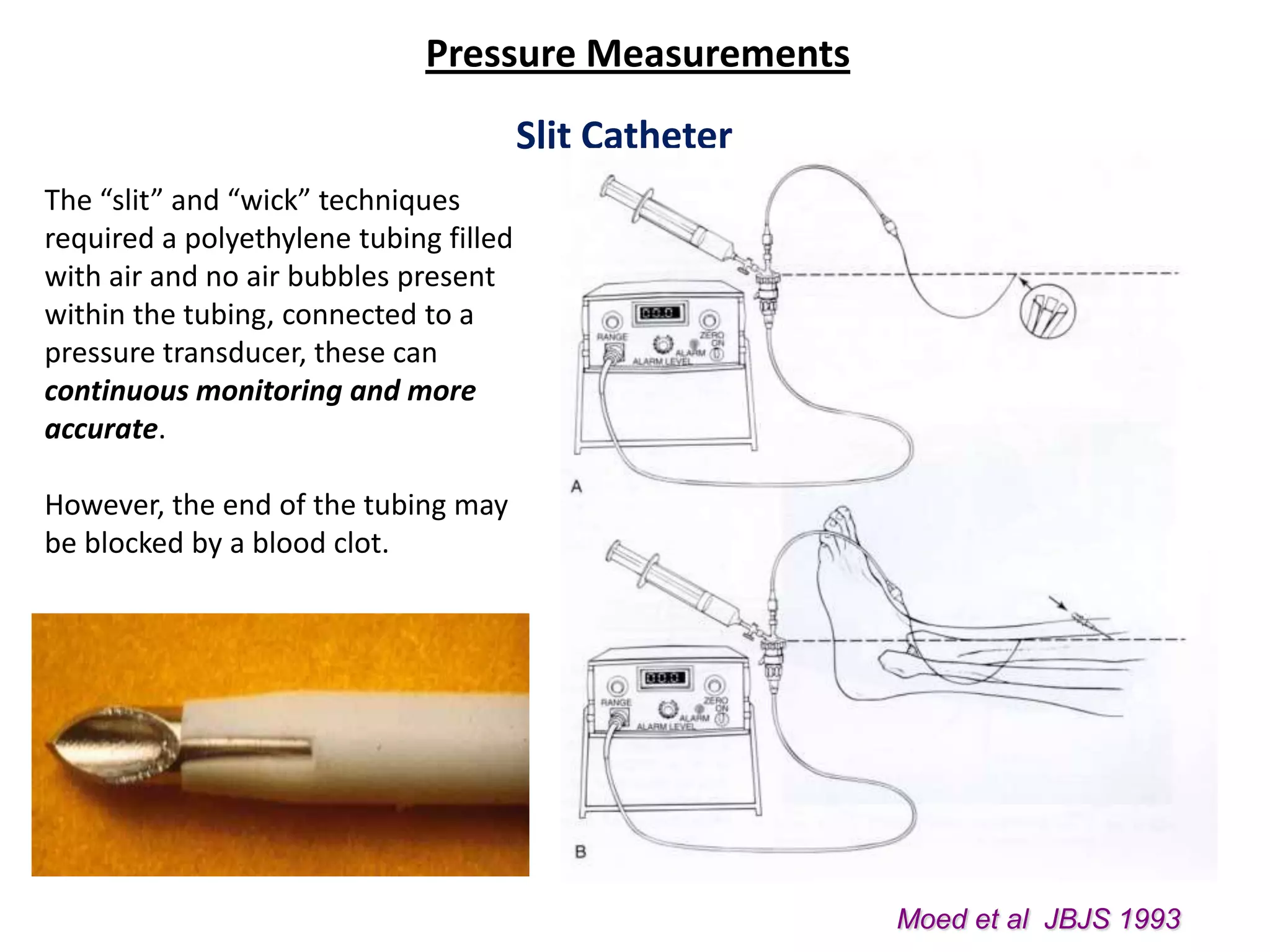 Compartment syndrome | PPTX