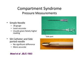 Compartment syndrome | PPT