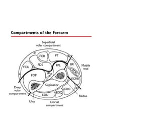 Compartment syndrome | PPT