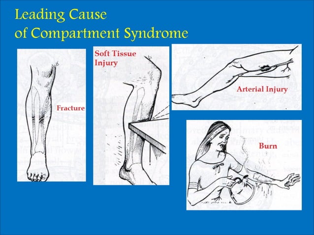 Compartment syndrome | PPT
