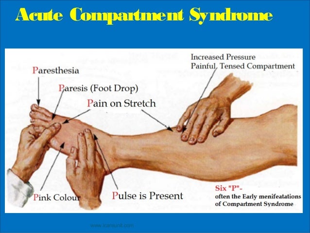 Compartment syndrome