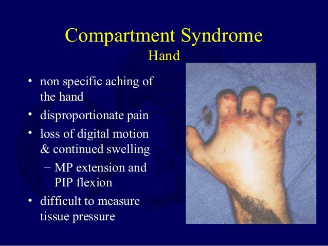 Compartment syndrome