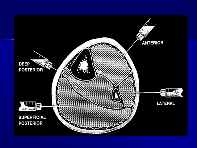 Compartment syndrome | PPT