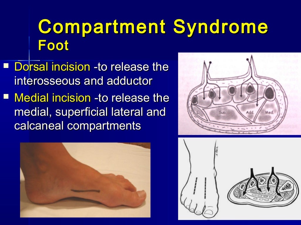 Compartment syndrome