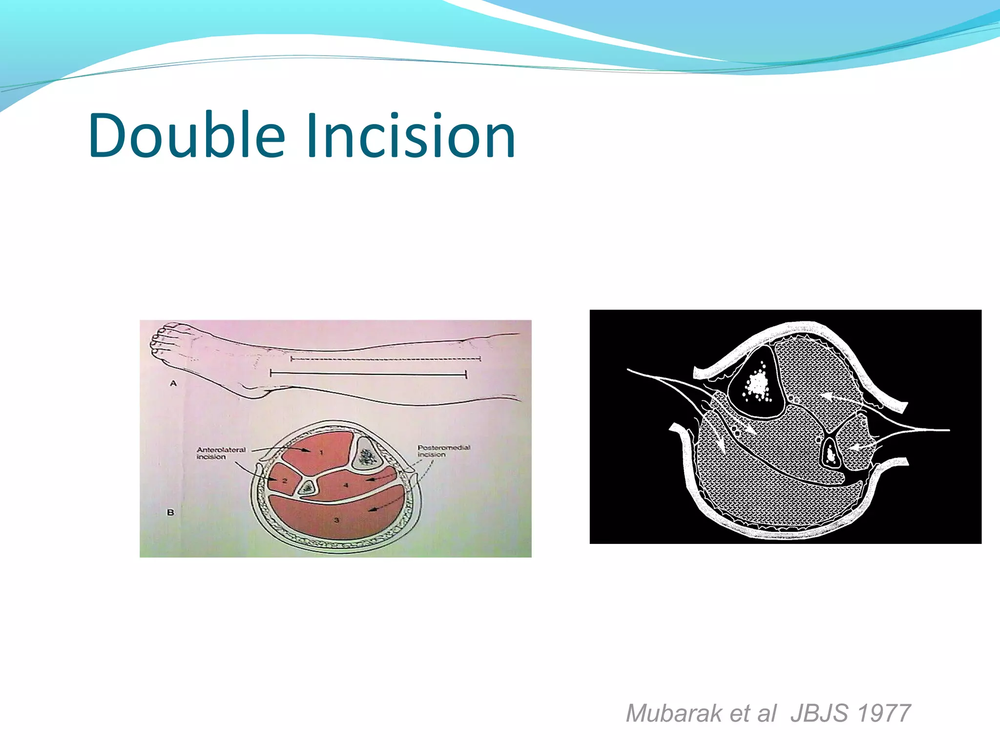 Compartment syndrome | PPT
