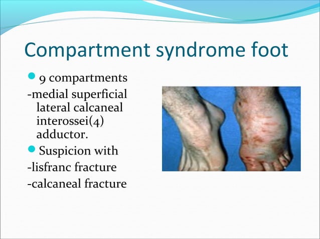 Compartment syndrome | PPT