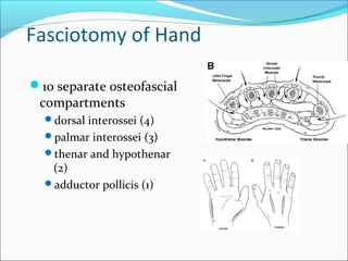 Compartment syndrome | PPT