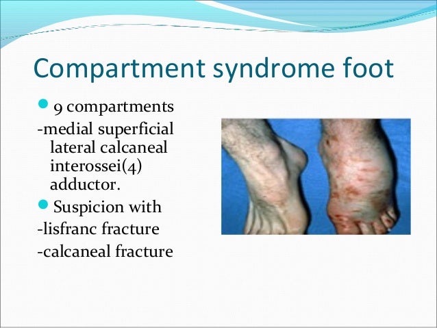 Compartment syndrome