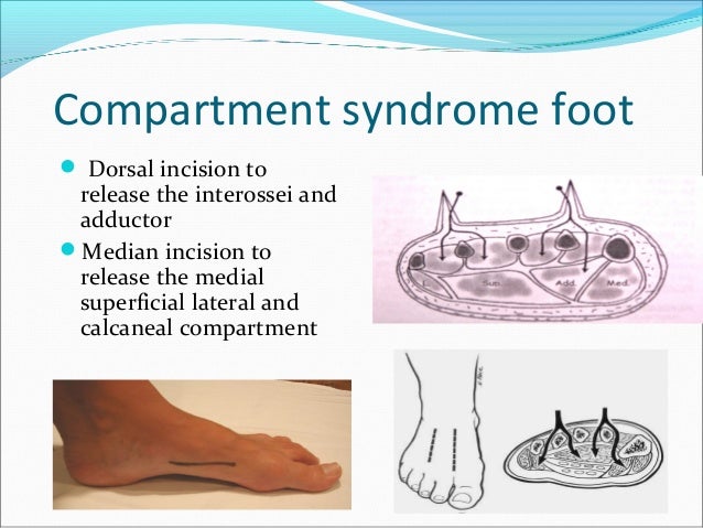 Compartment syndrome