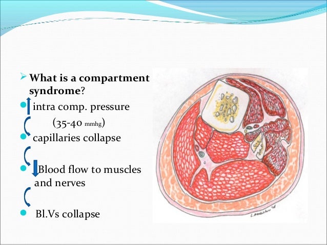 Compartment syndrome