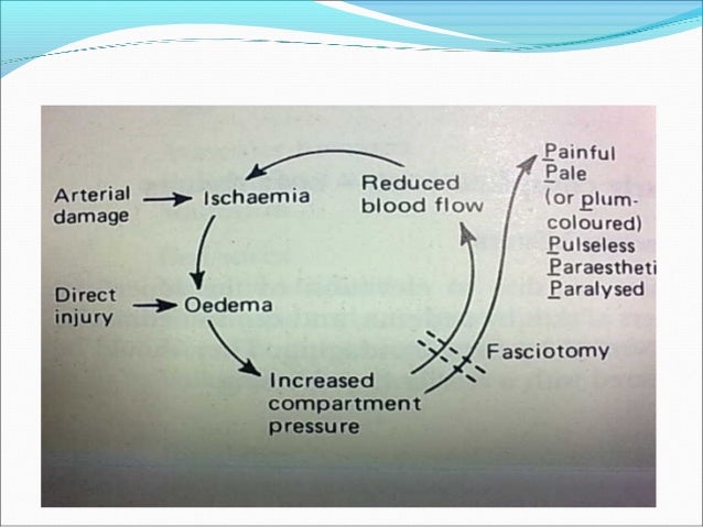 Compartment syndrome