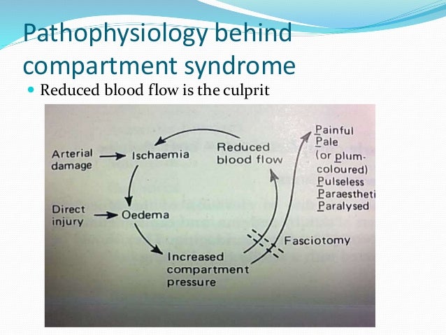 Compartment syndrome