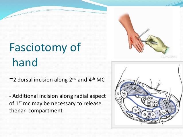 Compartment syndrome