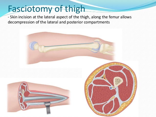 Compartment syndrome