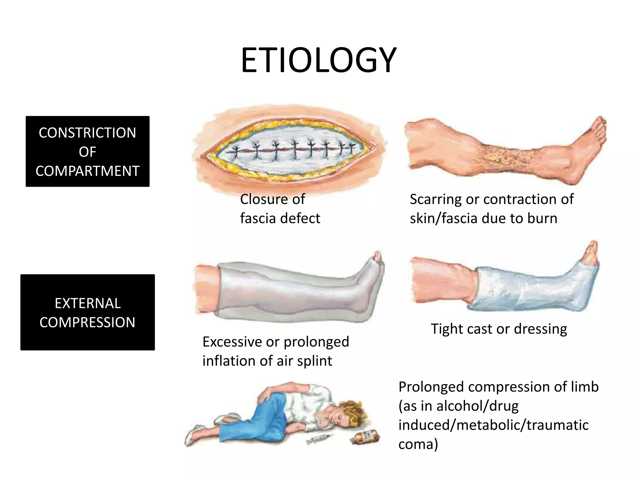 Compartment syndrome | PPTX