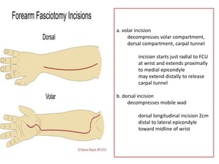 Compartment syndrome | PPTX