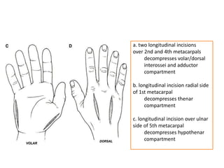 Compartment syndrome | PPTX
