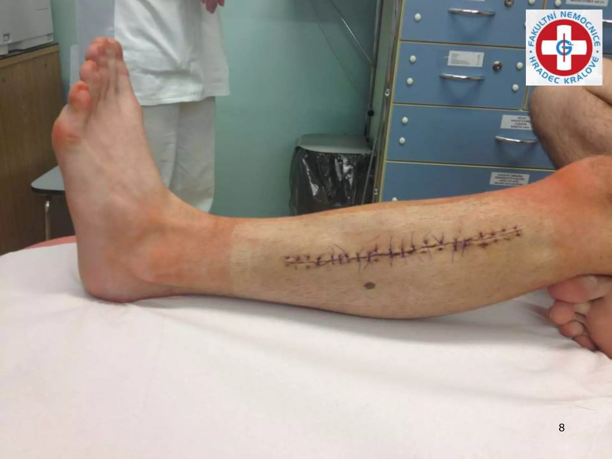 Compartment syndrome | PPTX