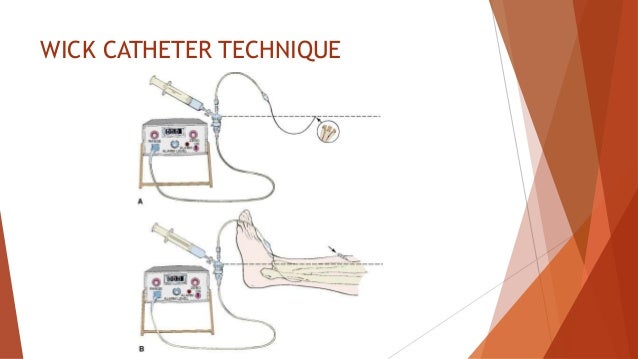 Compartment syndrome