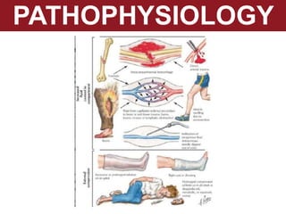 Compartment syndrome | PPTX