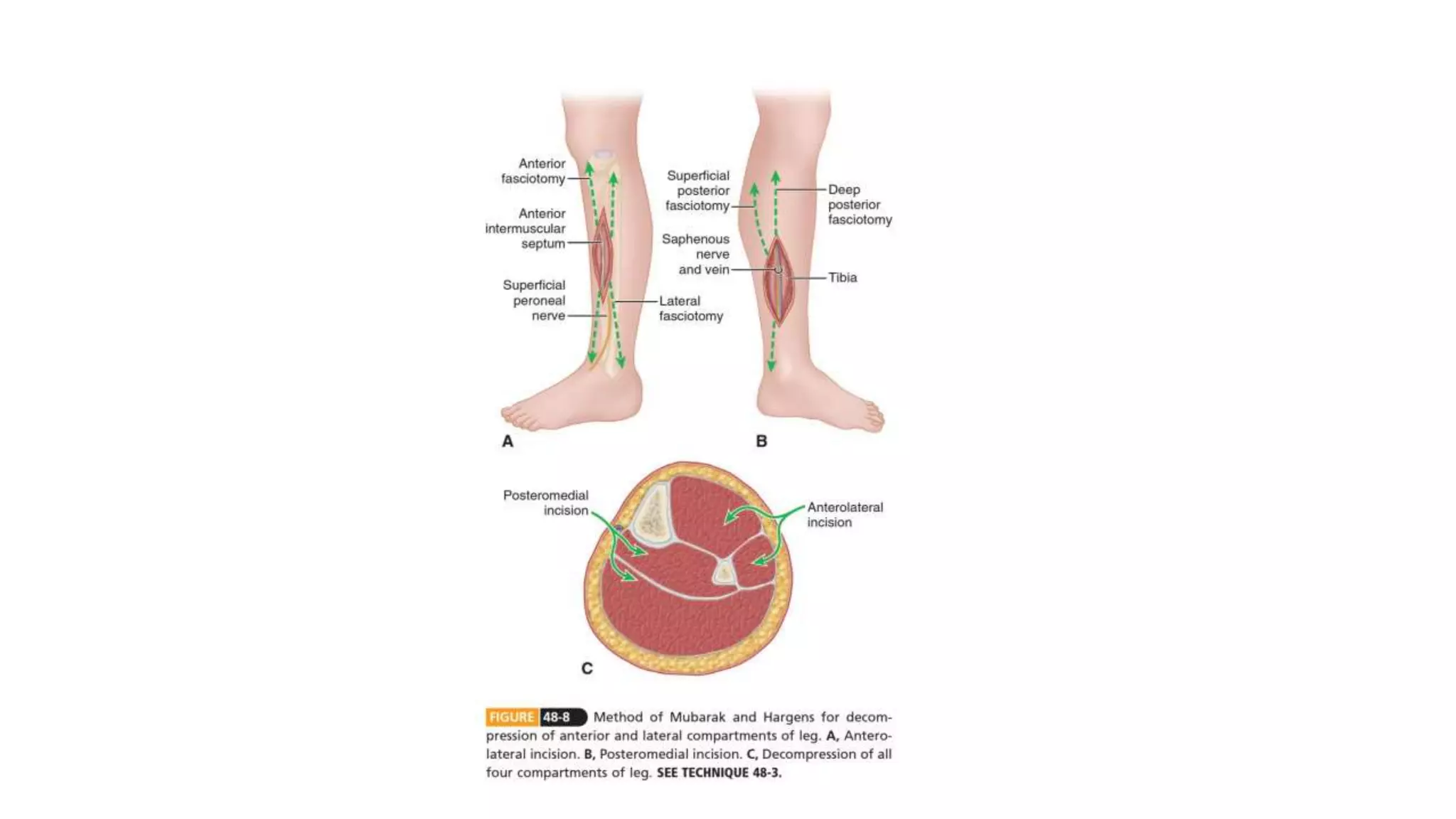COMPARTMENT SYNDROME | PPTX