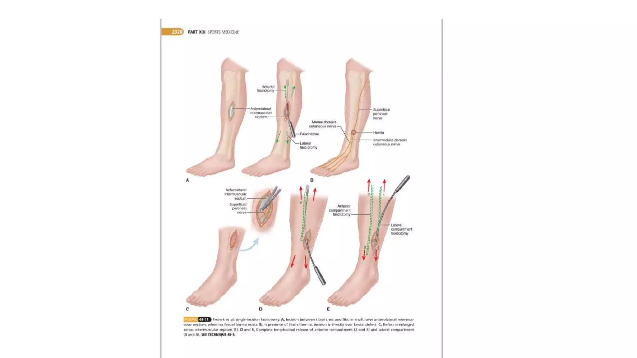COMPARTMENT SYNDROME | PPTX