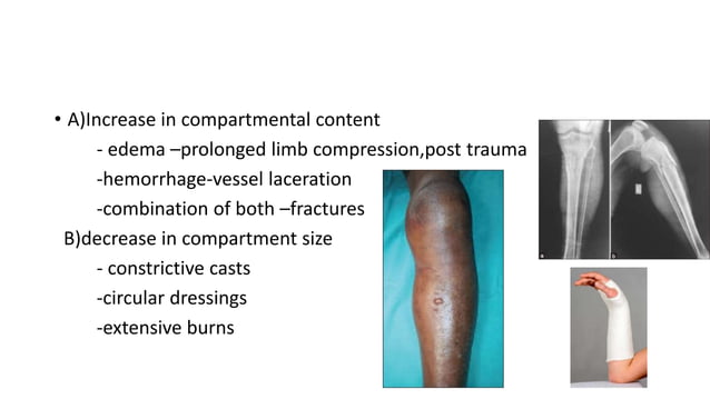 COMPARTMENT SYNDROME | PPT