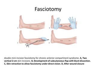 Compartment syndrome | PPTX