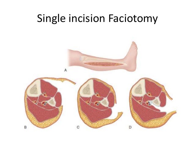 Compartment syndrome