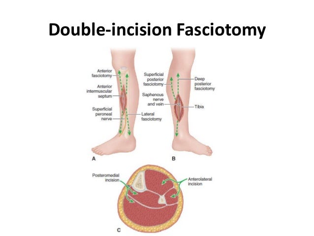 Compartment syndrome