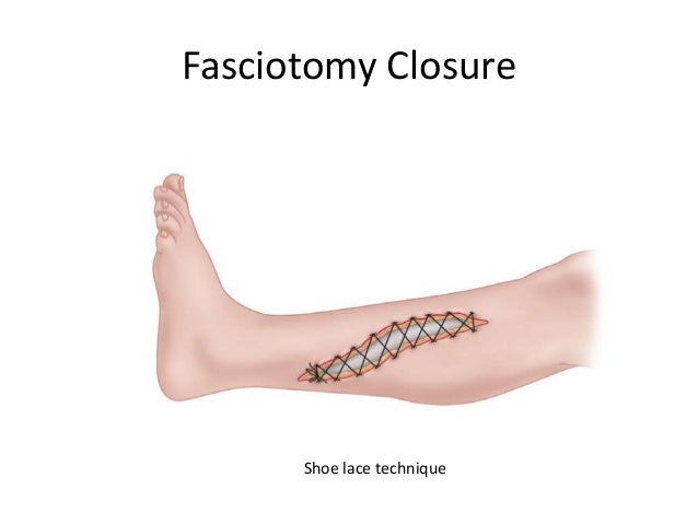 Compartment syndrome