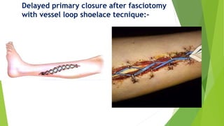 Compartment syndrome | PPT