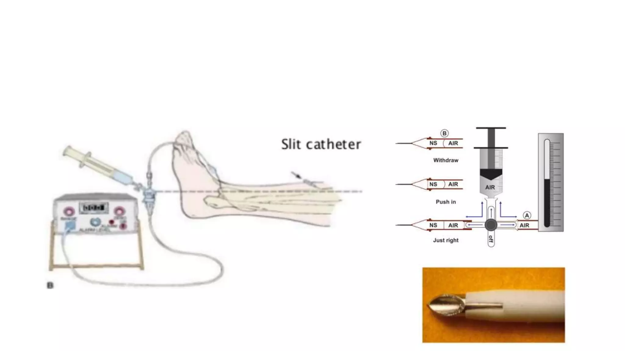 Compartment syndrome | PPTX