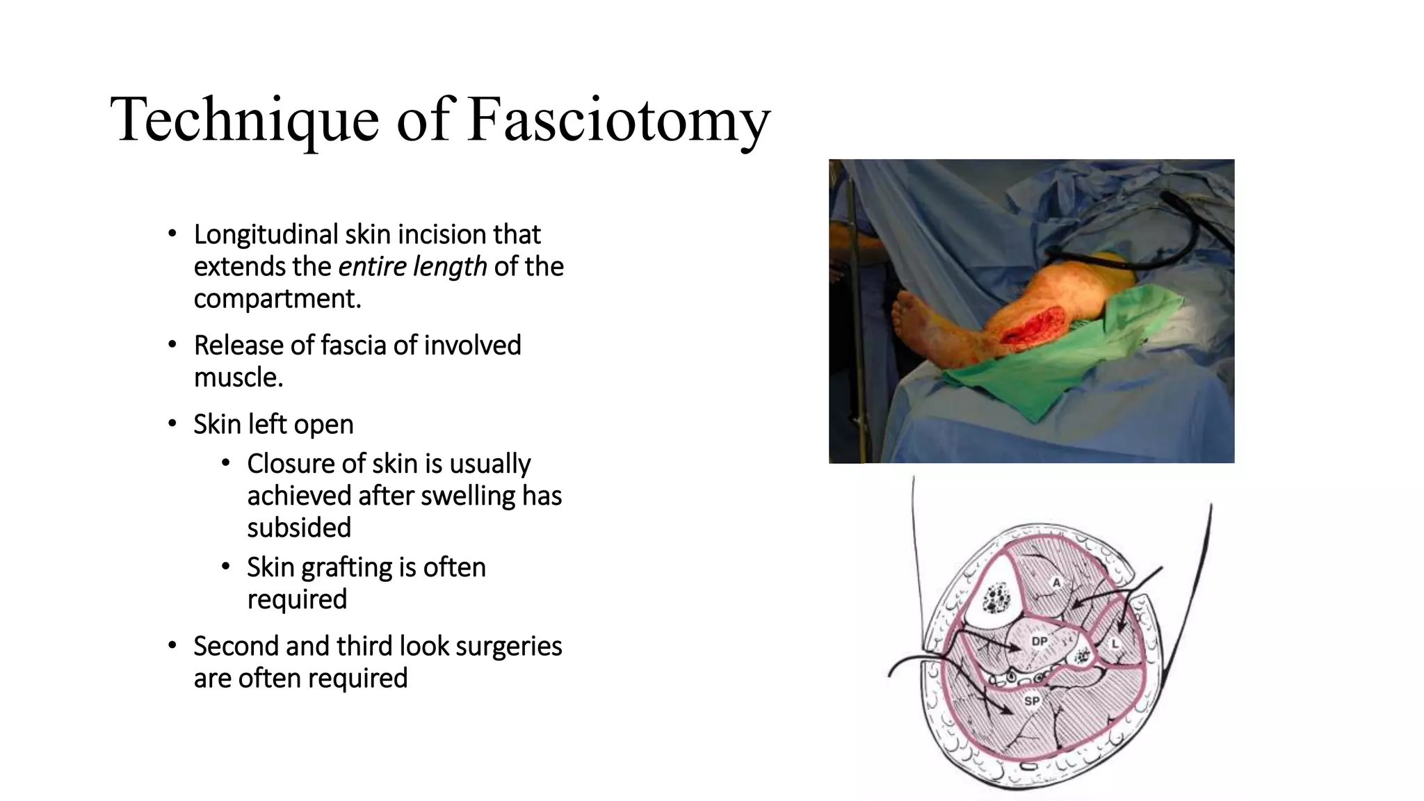 Compartment syndrome.ppt