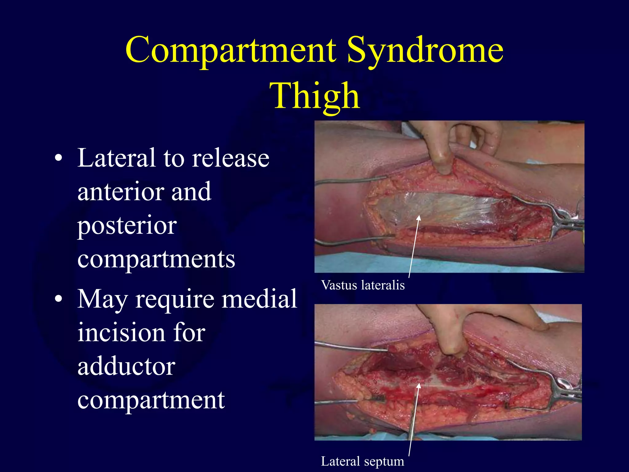 Compartment Syndrome.ppt